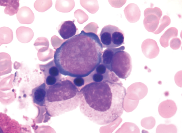 Pathologies du Globule Rouge et du Fer - Horizons Hémato