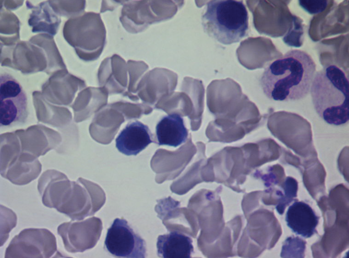 Pathologies du Globule Rouge et du Fer - Horizons Hémato