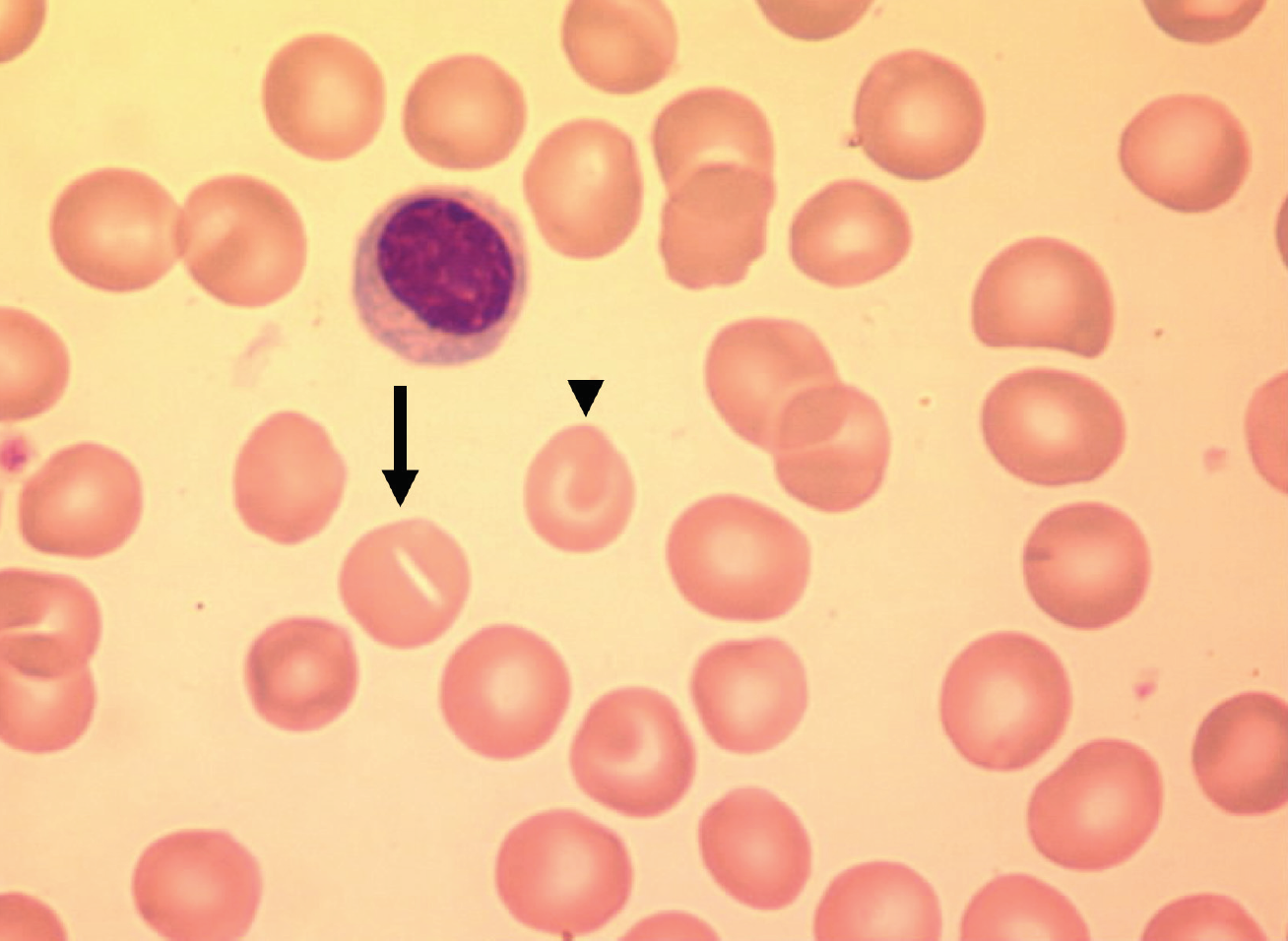 Pathologies du Globule Rouge et du Fer - Horizons Hémato
